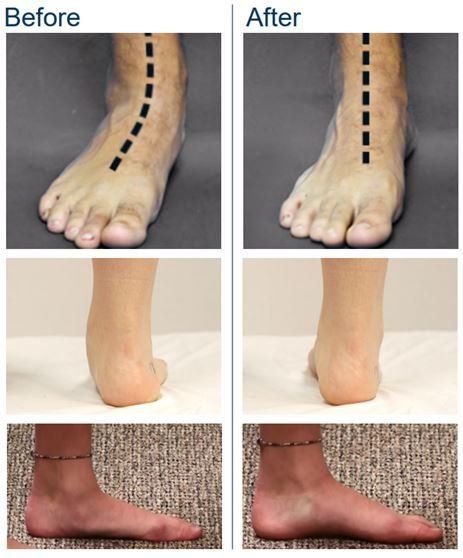 Flat Foot Surgery | Lakeland, FL | Bartow, FL