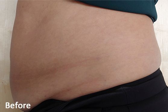 Body Contouring Services | Darien, CT