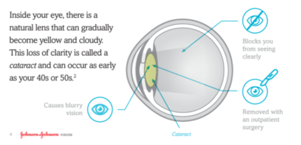 Cataract Surgery | Dropless Cataract Surgery | Louisville KY
