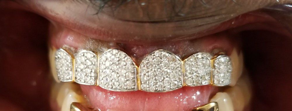 Gold Crowns | Gold Dental Work | Mobile, AL