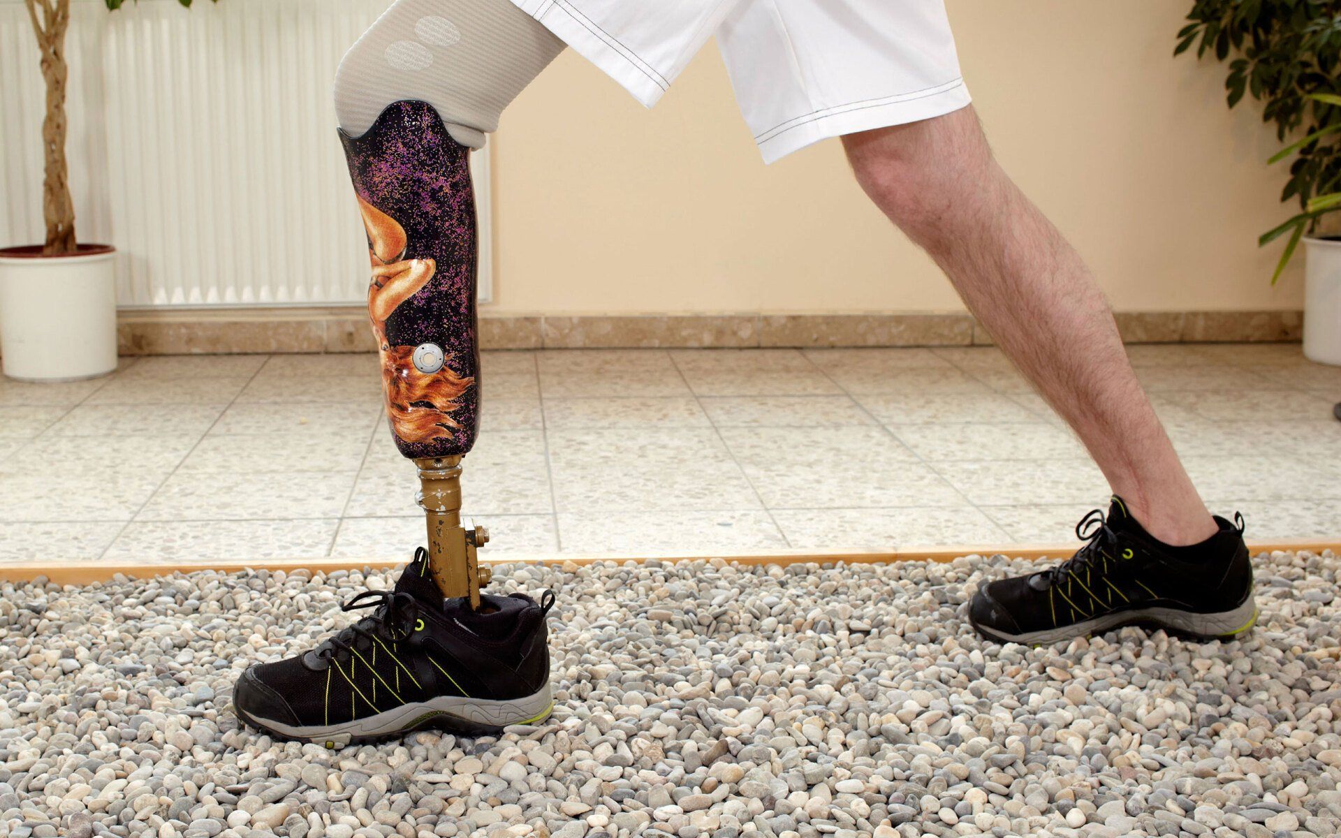 Contact Bickert's Orthotics & Prosthetics | Corinth, MS