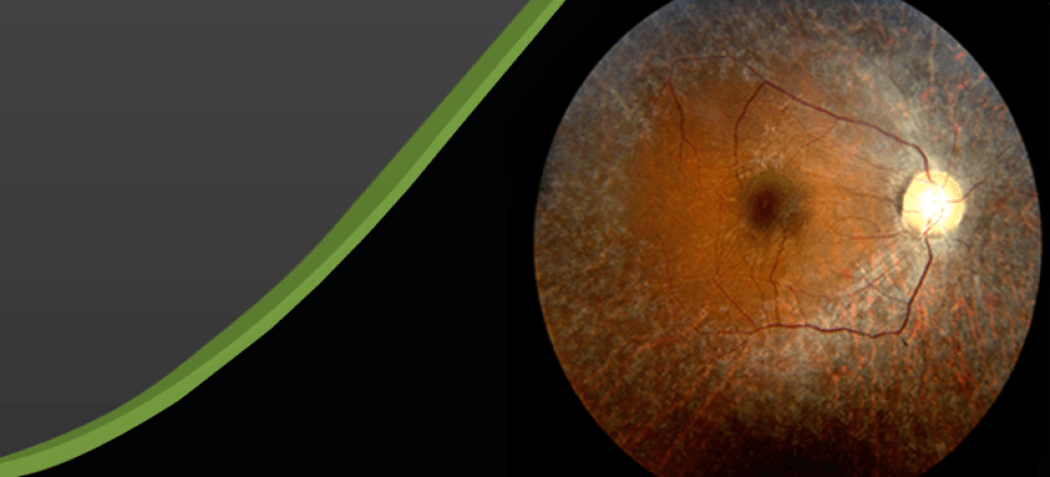 Vitreo Retinal Diseases | Vitreo Retinal Associates PA | 352-371-2800