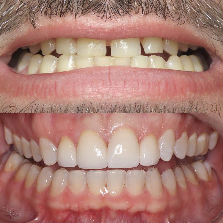 Invisalign | Smile Improvement | Brandon, MS